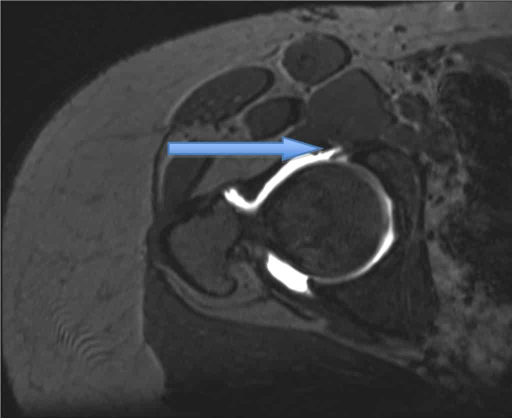 Hip arthroscopy and femoroacetabular impingement – where are we now ...