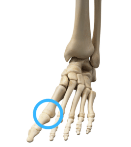 Understanding Bunions - London Bridge Orthopaedics