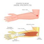 Golfer’s Elbow (Medial Epicondylitis) - London Bridge Orthopaedics
