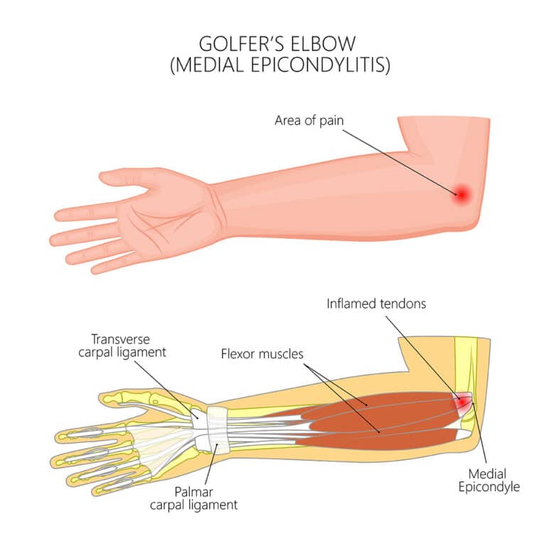 Golfer’s Elbow (Medial Epicondylitis) - London Bridge Orthopaedics